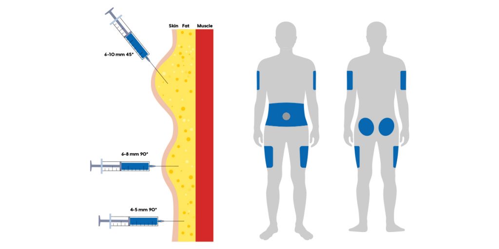 The Basics Of Insulin Injection Sites On The Body – Where And How To ... The Basics Of Insulin Injection Sites On The Body – Where And How To ...